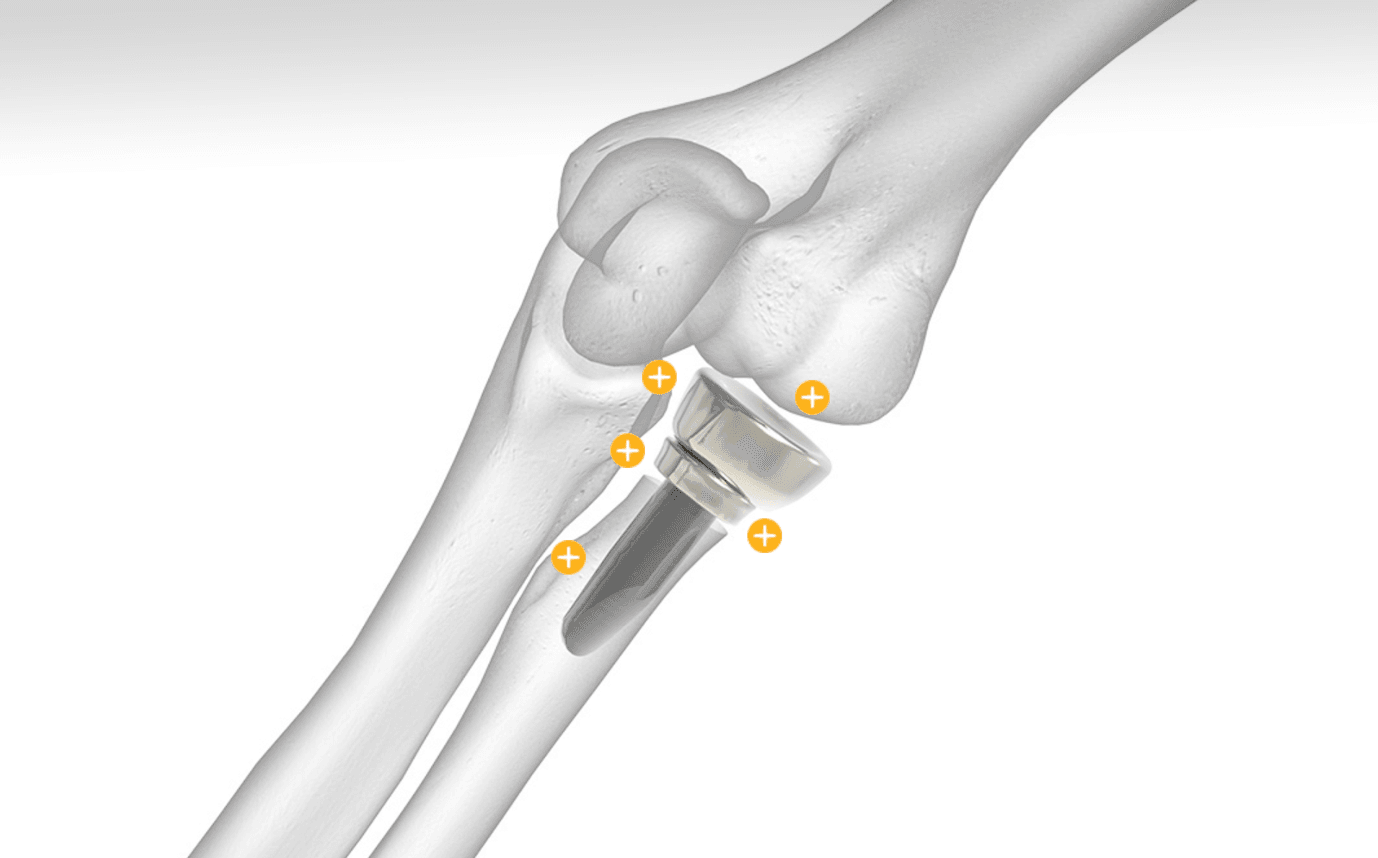 Radial head replacement | Ortho Globe