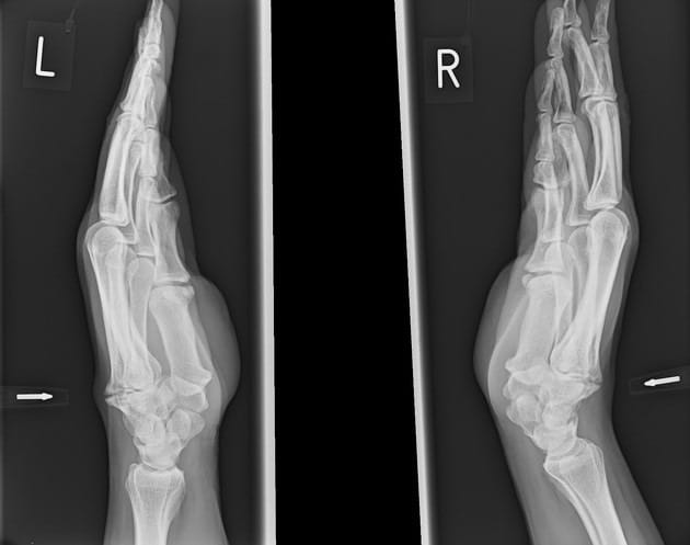 Carpal Boss | Ortho Globe