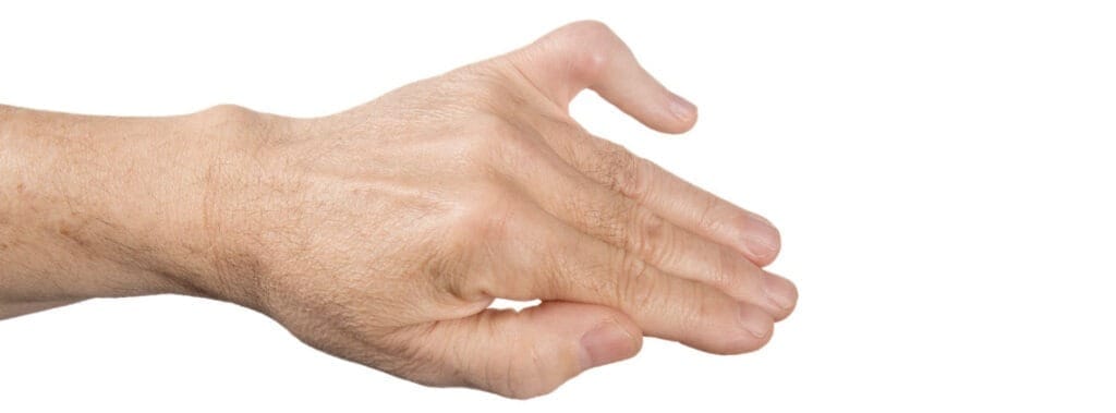 Ortho Globe | Boutonnière Deformity