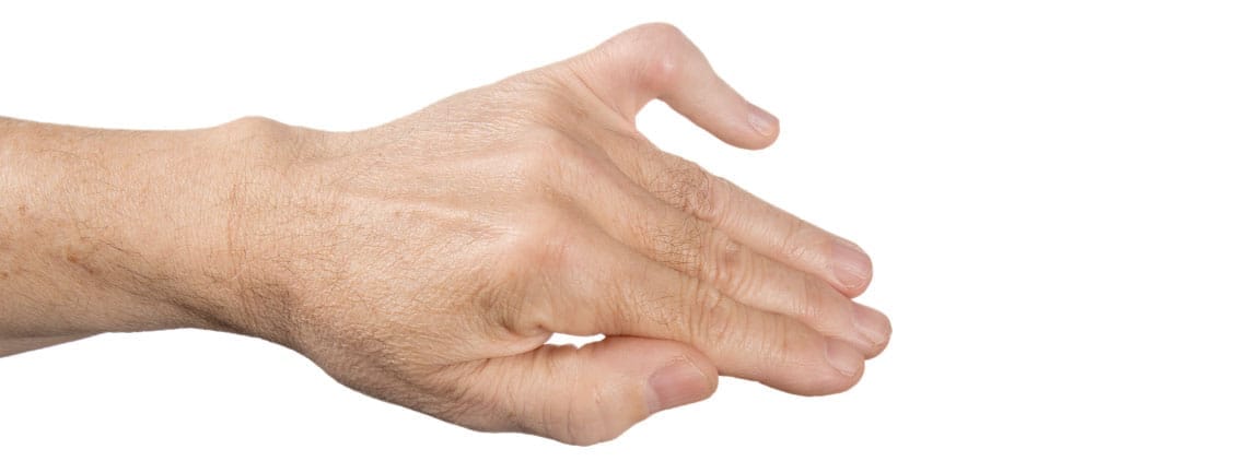 Ortho Globe | Boutonnière Deformity