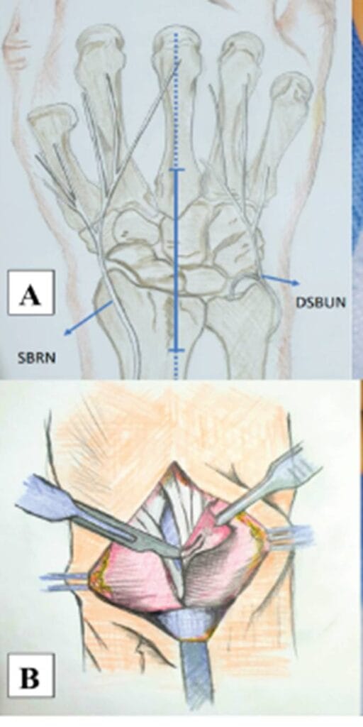Ortho Globe | Lunotriquetral Ligament Injury