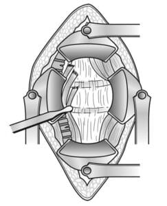 Ortho Globe | Understanding Anterior Lumbar Interbody Fusion (ALIF) in ...