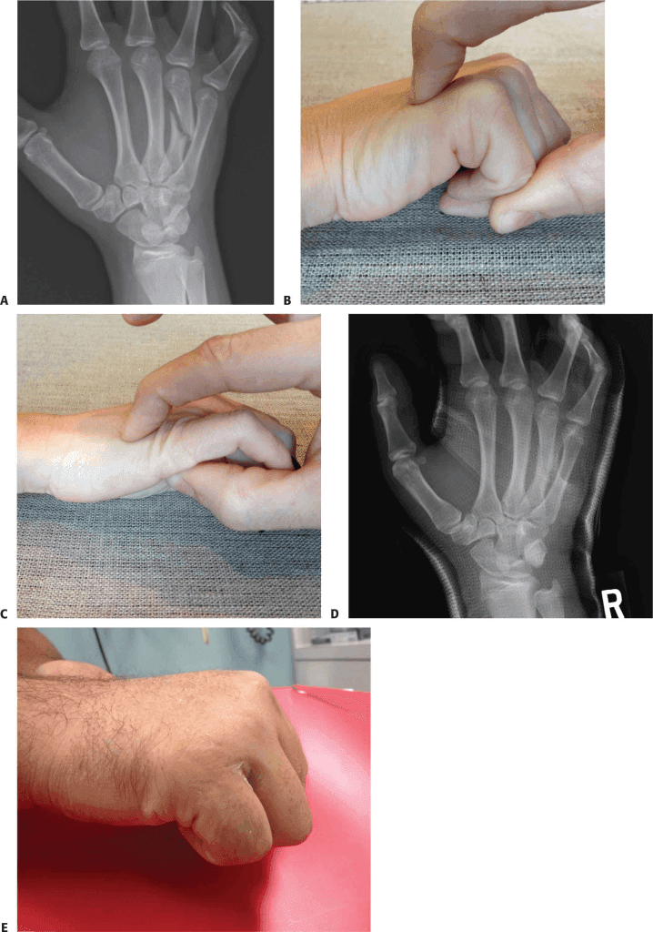 Ortho Globe Metacarpal Fractures