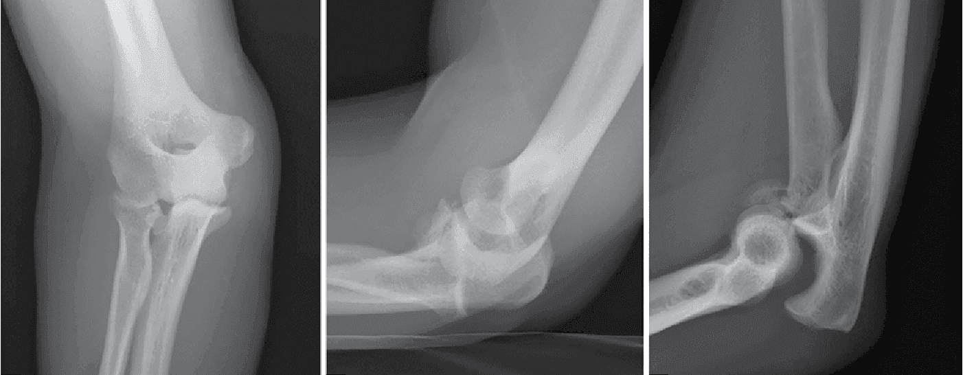 Ortho Globe | Terrible Triad Injury of the Elbow