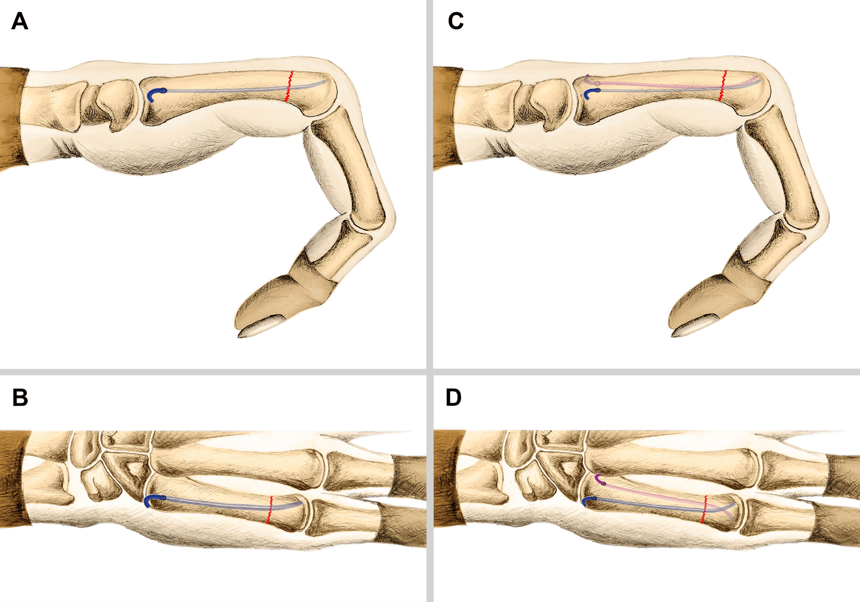 Ortho Globe | Metacarpal Fractures