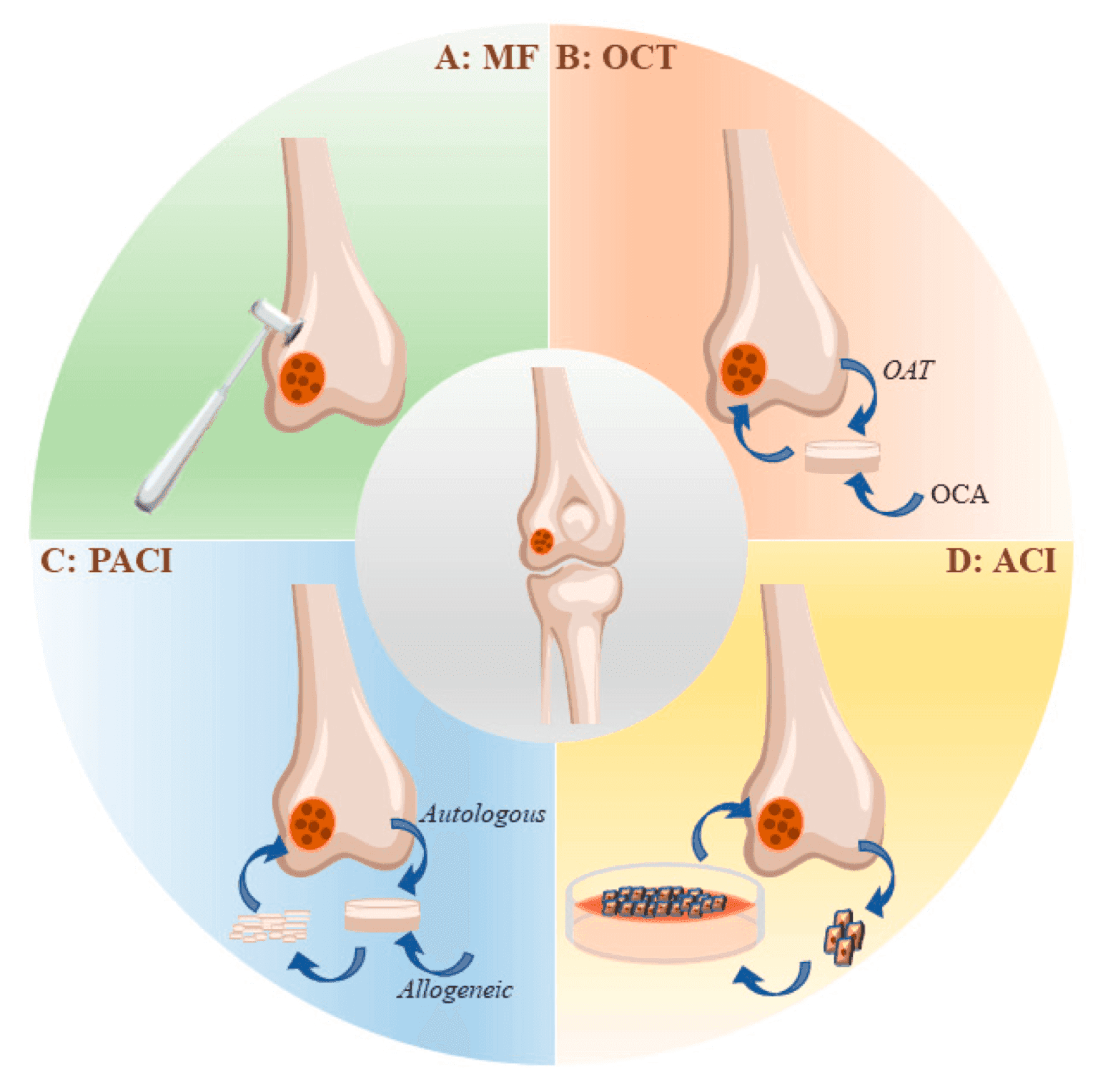 Ortho Globe | Simplifying the complex: complex bone fractures explained