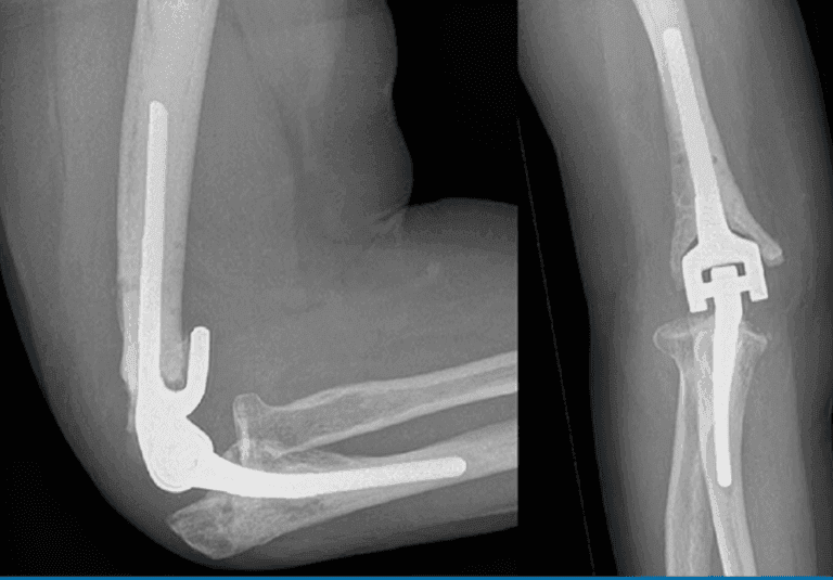 Total Elbow Arthroplasty: An Overview of Modern Clinical Approaches ...