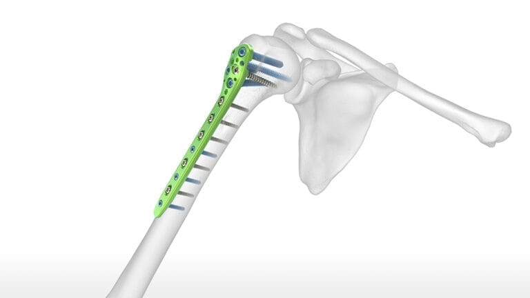 Ortho Globe | Humeral Shaft Fractures
