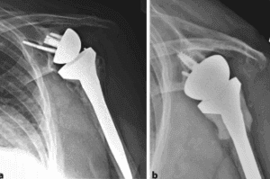 Ortho Globe | Periprosthetic Humeral Fractures