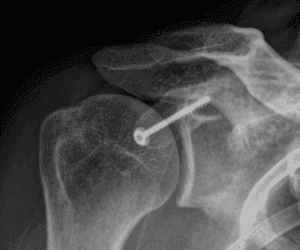 Ortho Globe | Coracoid Fractures