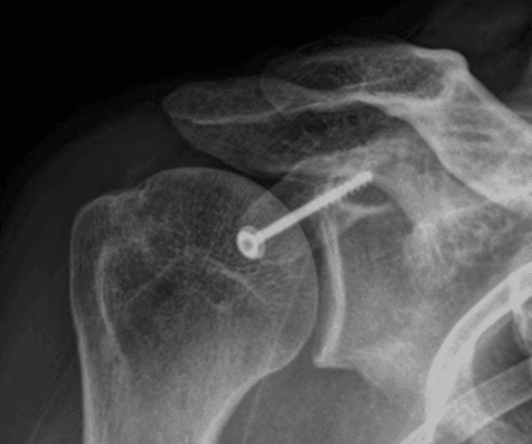 Ortho Globe | Coracoid Fractures