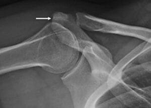 Ortho Globe | Os Acromiale