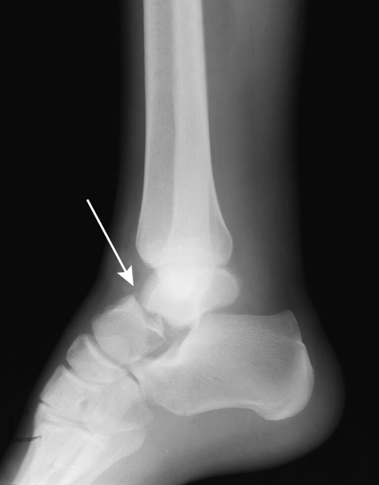 Ortho Globe | Talus Fractures: Causes, Treatments, Complications