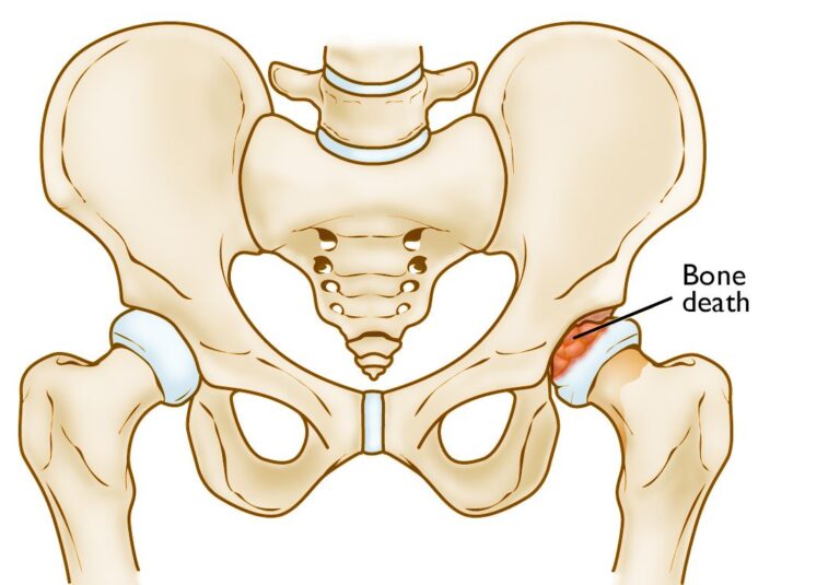 Ortho Globe | Understanding Perthes Disease: Causes, Stages, and ...