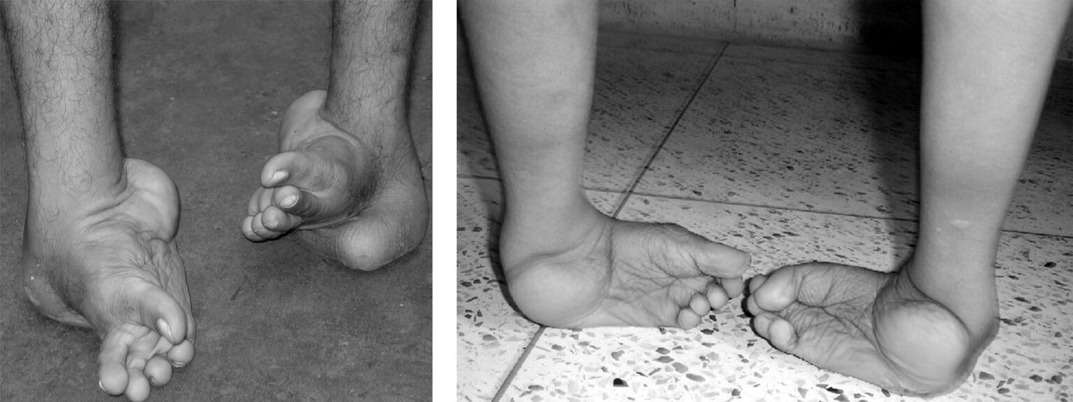 Ortho Globe | Understanding and Treating Clubfoot: Early Intervention ...