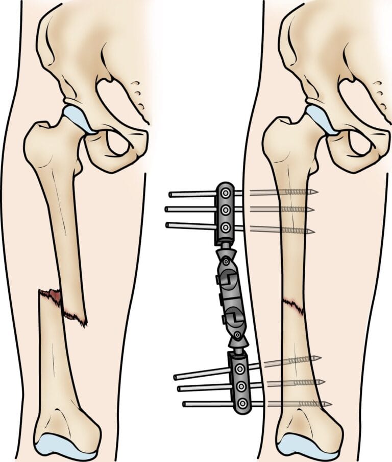 Ortho Globe | Understanding Femoral Shaft Fractures: Causes, Treatment, and Recovery