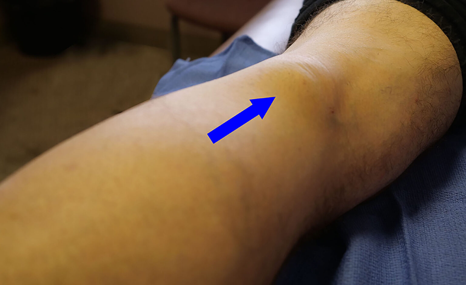 Ortho Globe | Understanding Baker's Cyst: Causes, Symptoms, and ...