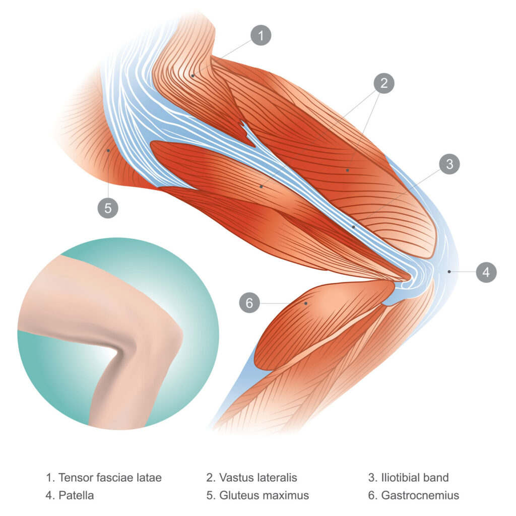 Ortho Globe | Understanding Iliotibial Band Syndrome: Causes, Symptoms ...