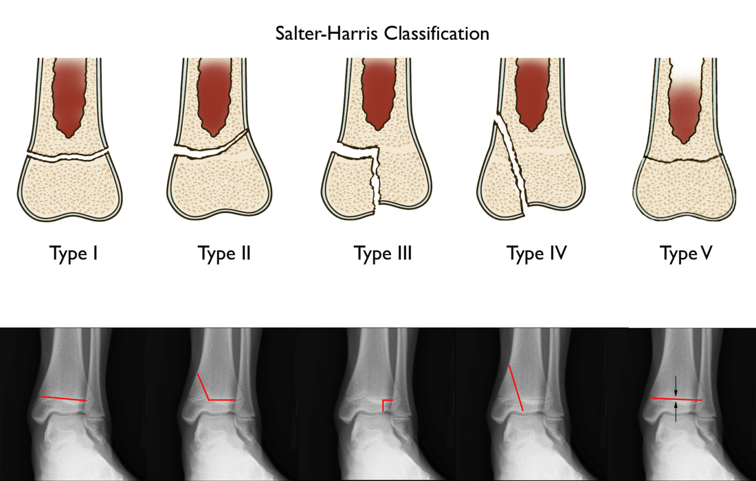 Ortho Globe | Understanding Pediatric Ankle Fractures: Causes ...