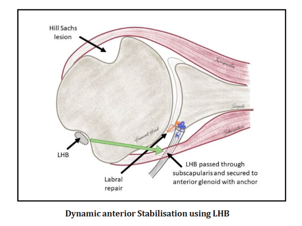Ortho Globe | Our New Classification for Shoulder Instability