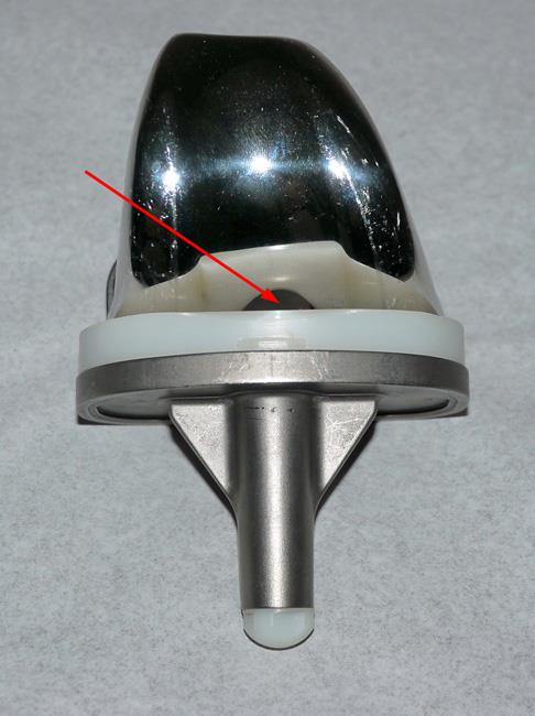 Ortho Globe | Knee Replacement Implants