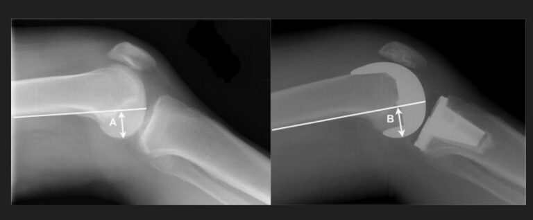 Ortho Globe | Surgical Lines in Total Knee Arthroplasty (TKA)