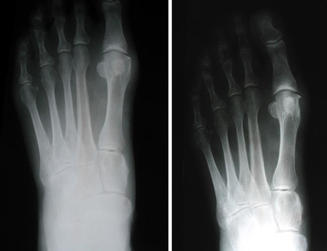 Ortho Globe | Bunion Surgery