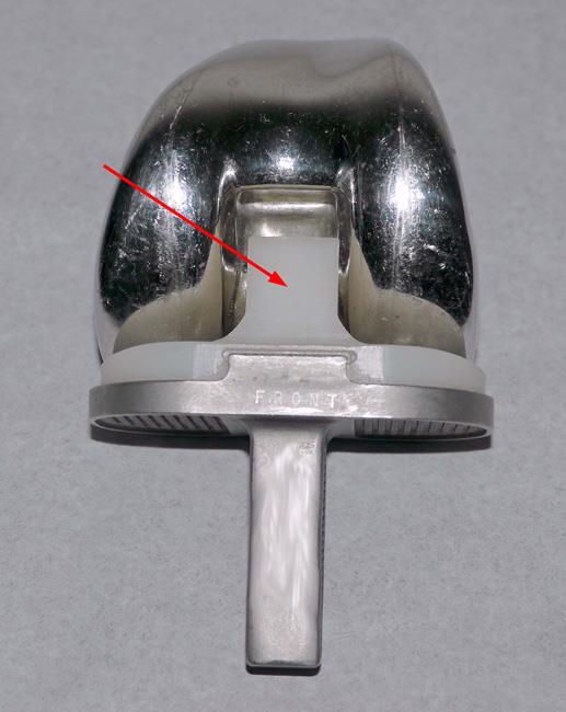 Ortho Globe | Knee Replacement Implants