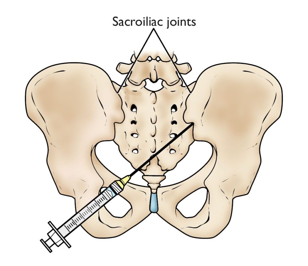 Ortho Globe | Spinal Injections: Uses and Risks