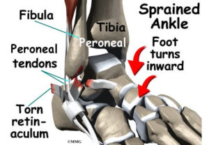 Ortho Globe | Peroneal Tendon Subluxation