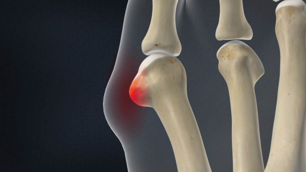 Ortho Globe | Bunionette (Tailor's Bunion)