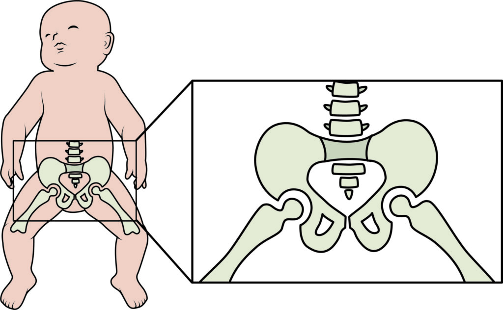 Ortho Globe | Developmental Dysplasia of the Hip (DDH)